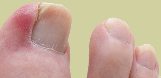 Cómo curar los uñeros 2025